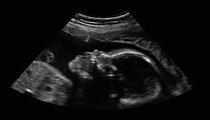 Fetus-in-fetu case: One-year-old girl found with 3.5 kg fetus inside ...