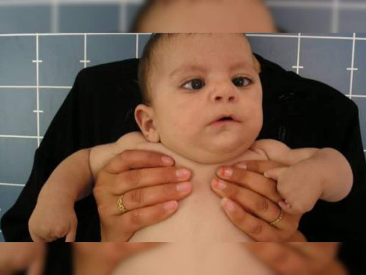 Moebius Syndrome Awareness Day: Know the signs and symptoms of this ...