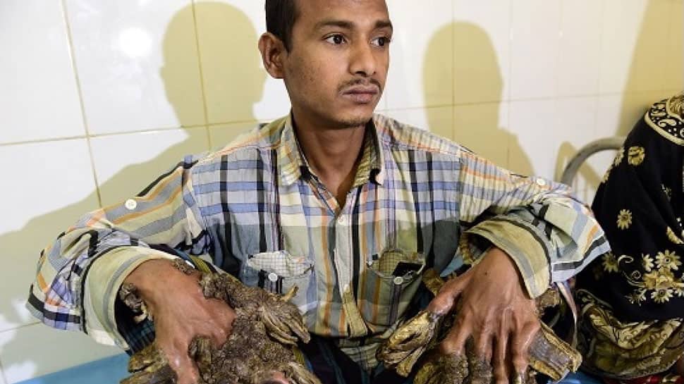Despite 25 surgeries, 'tree-man' in Bangladesh still hasn't been cured ...