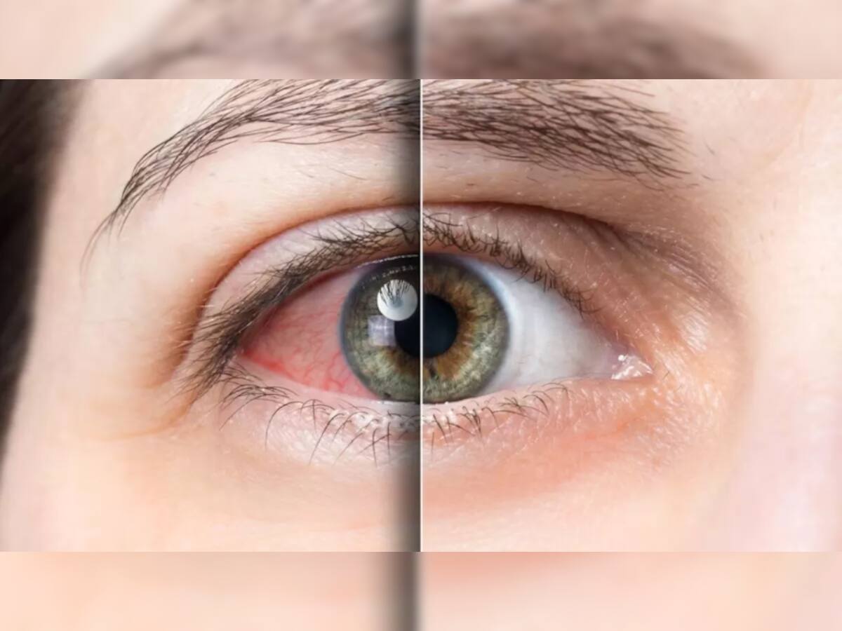 7 Tips to Prevent Eye Flu During Monsoon Season