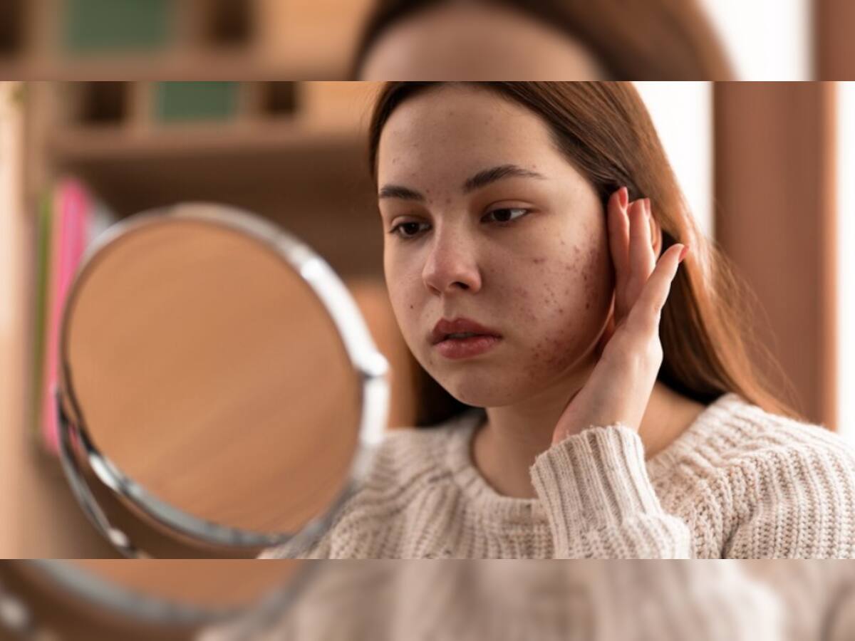 Acne In Your 20s? Know Why It Happens And How To Treat It