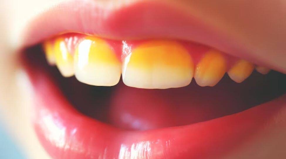 8 Ways To Whiten Your Yellow Teeth At Home | News | Zee News