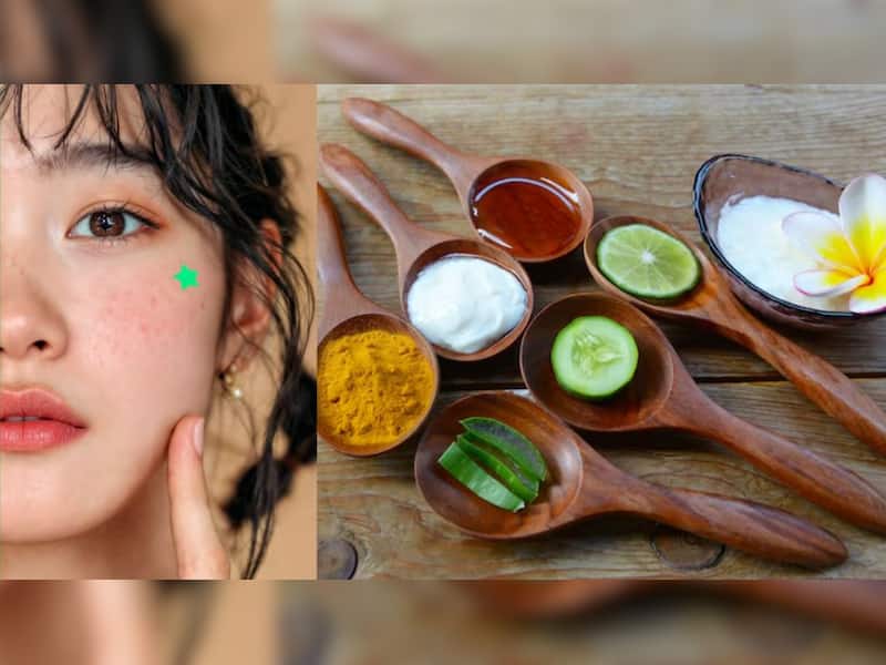 Natural Remedies For Acne And Pimples: 10 Popular DIY Face Packs For ...