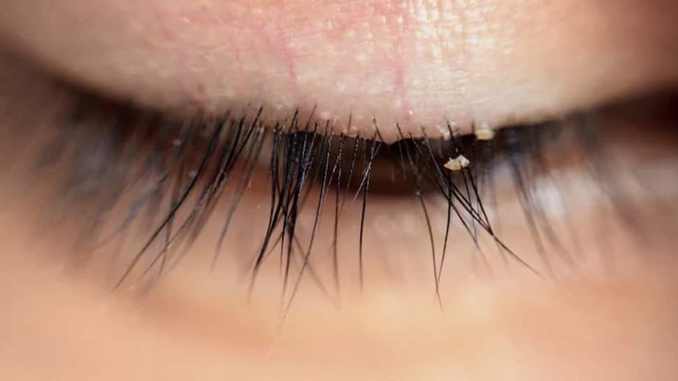 7 Common Symptoms Of Eyelash Dandruff
