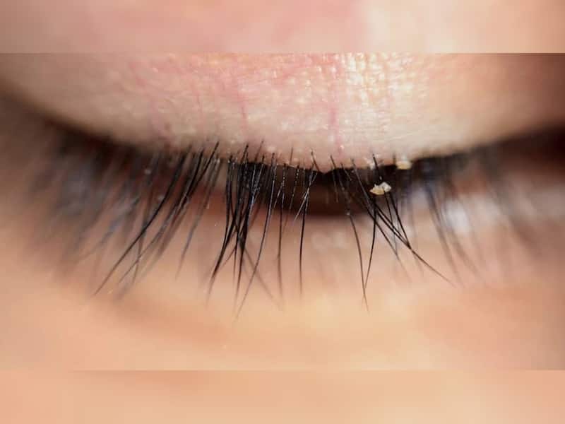 7 Common Symptoms Of Eyelash Dandruff | News | Zee News