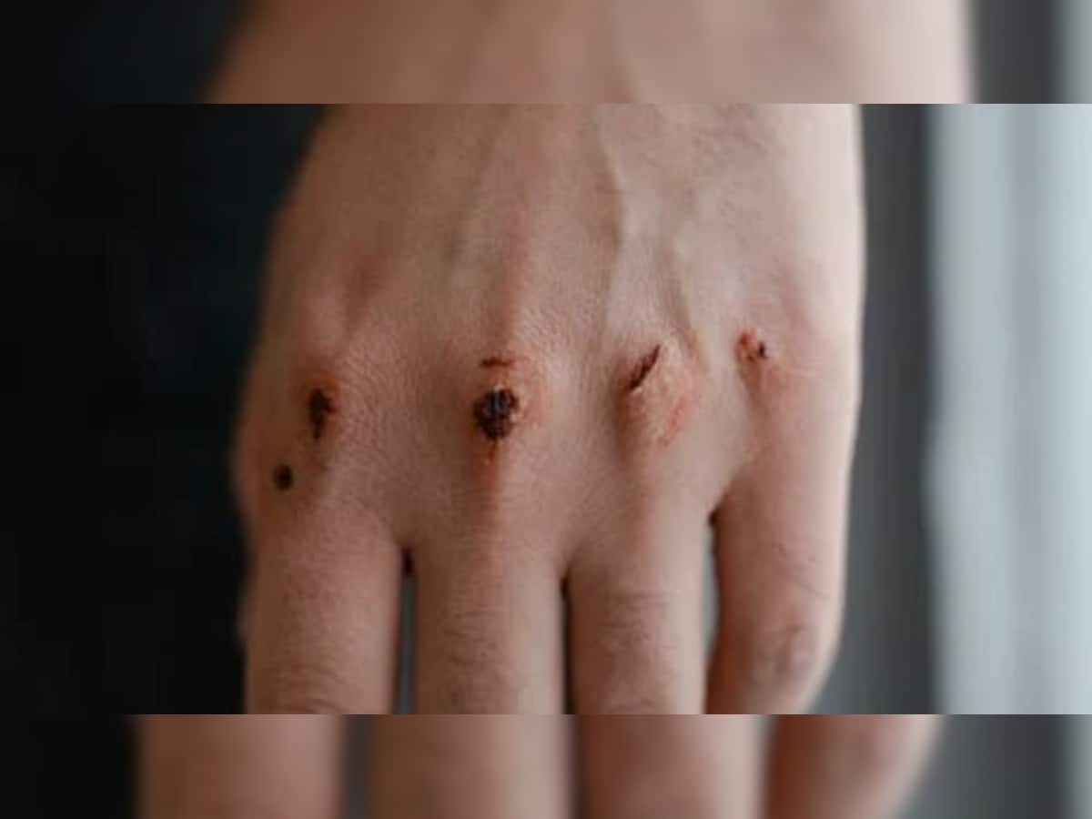 How To Get Rid Of Dark Knuckles: Causes, Remedies, And Prevention