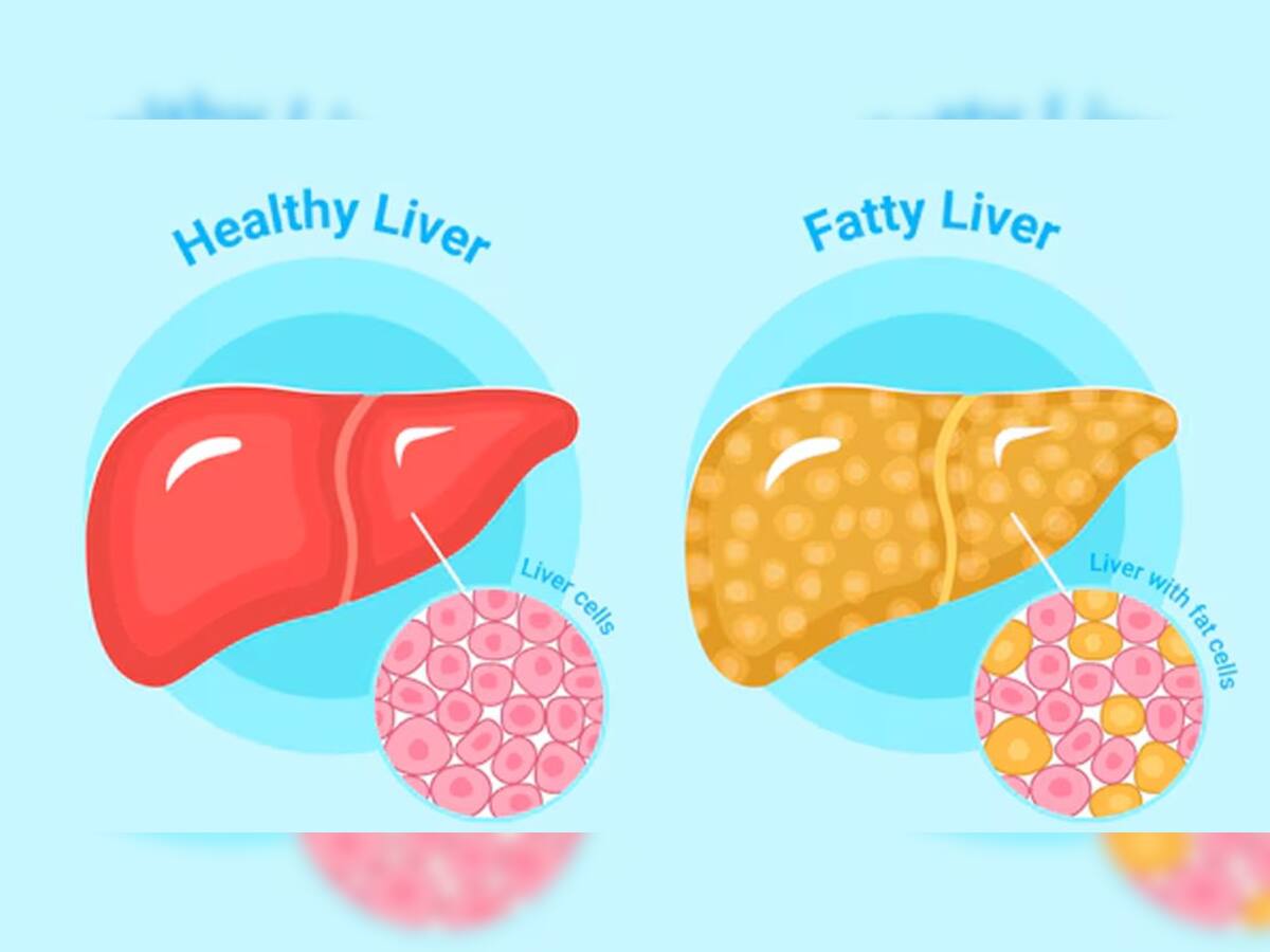 Is Sedentary Lifestyle Linked To Fatty Liver Disease? Expert Advice On ...