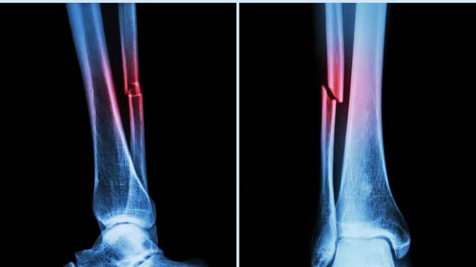 New AI Tool Detects Hidden Heart And Fracture Risks In Bone Scans ...