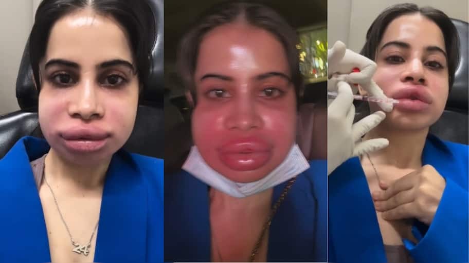 VIRAL VIDEO: Uorfi Javed REMOVED Lip Filler After 9 Years, Reveals ...
