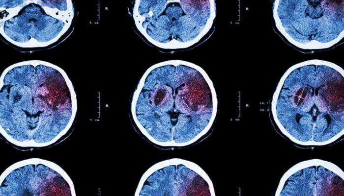 How office colleagues helped save brain stroke patient | Health News ...