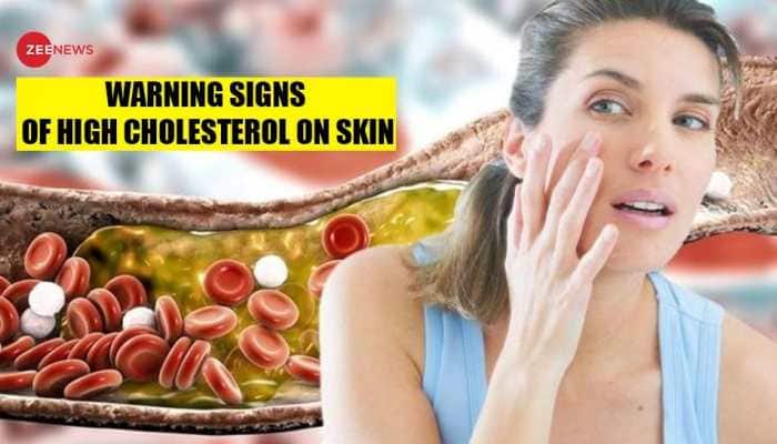 High cholesterol signs: Can high cholesterol affect your skin? Tips to ...