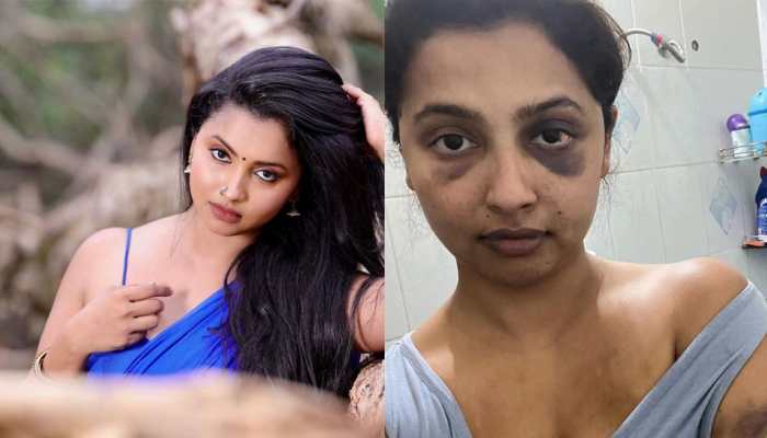 Malayalam Actress Anicka Vikhraman Shares Horrifying Pics of Bruise Marks, Accuses Ex-BF Of ...
