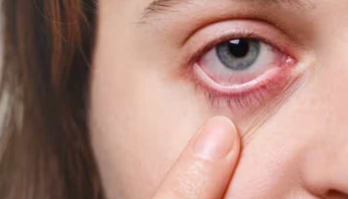 Eye Flu Cases On Rise In India: 10 Tips To Keep Your Kids Safe From ...