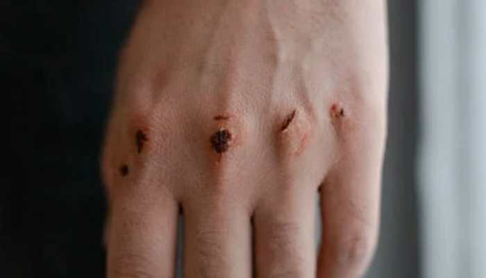 How To Get Rid Of Dark Knuckles: Causes, Remedies, And Prevention ...