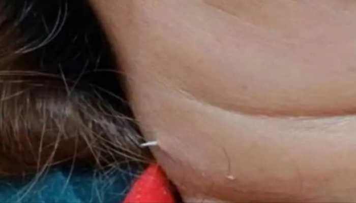 Medical Head-Scratcher: Fish Bone Pierces Woman's Neck Weeks After Soup ...